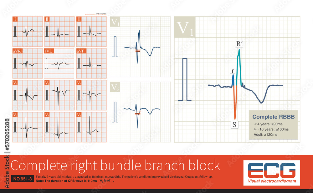 In 2009, American AHA ECG guidelines defined children aged 4 to 16 ...