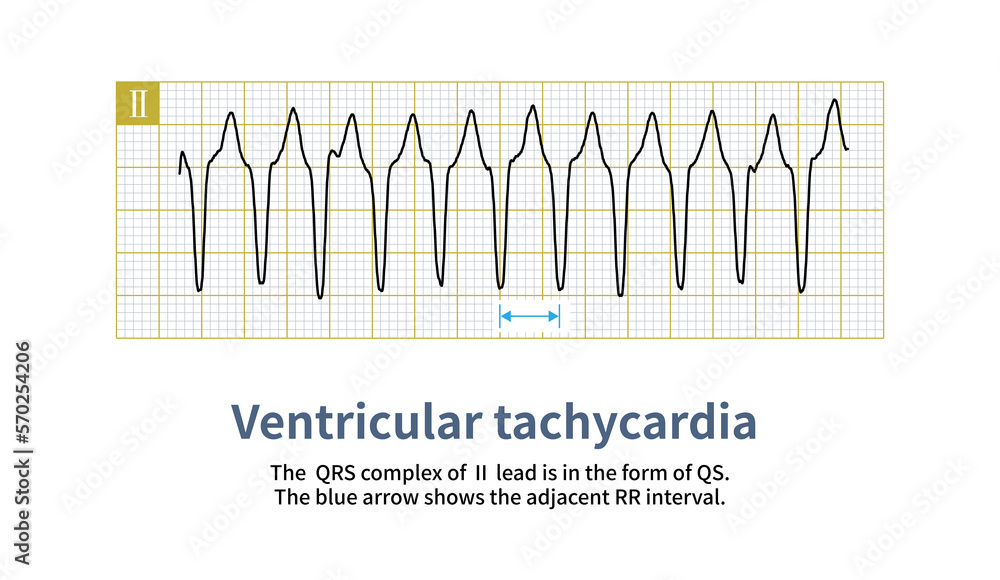 Poster The QRS wave of ventricular tachycardia can be either a wide QRS ...