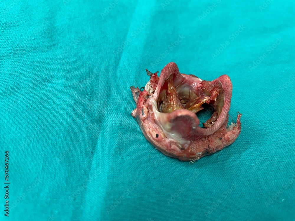 Degenerative mitral valve (MV) prosthetic in patient status ...