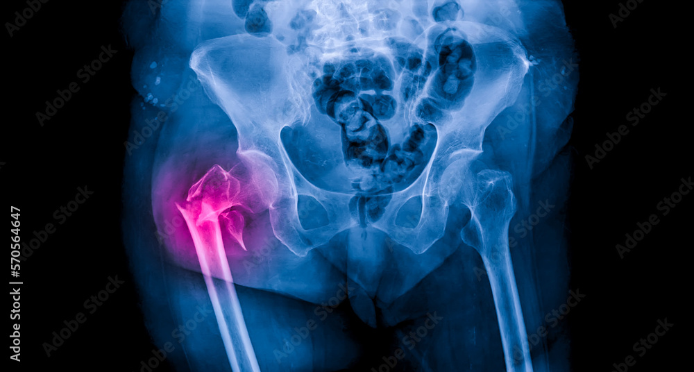 Radiograph on dark background in hospital.The xray is used for ...