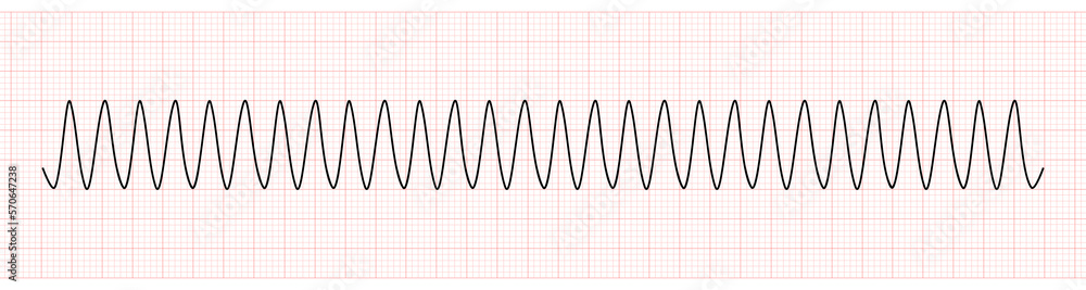EKG Monitor Showing Ventricular tachycardia or VT Stock Vector | Adobe ...