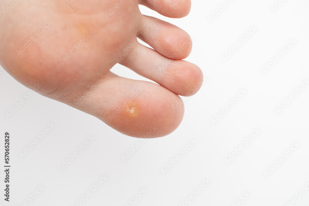 Plantar Wart On Big Toe Treatment at Arthur Thurlow blog