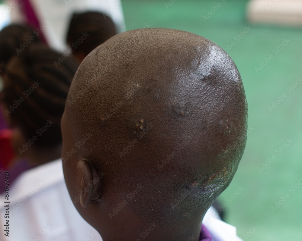 Back view of an unhealthy hairless African head infested with skin ...