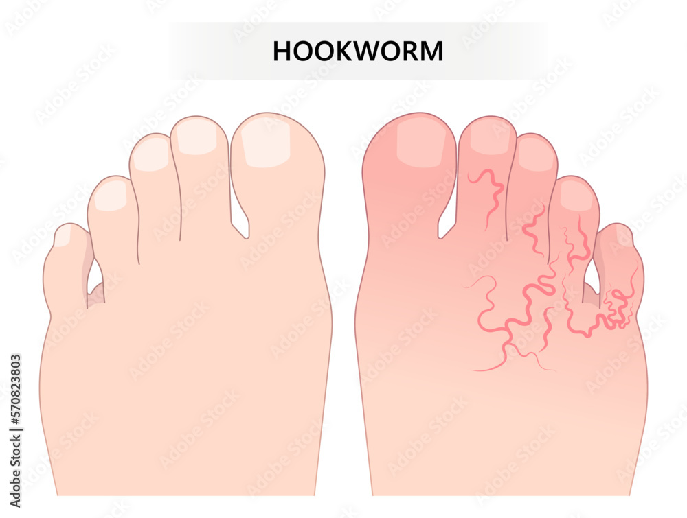 Skin rash pain feet parasitic worm intestinal small large bowel colon ...