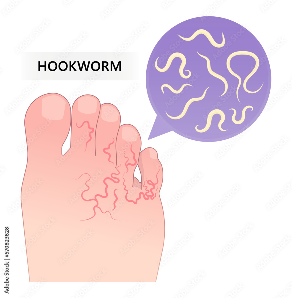 feet pain parasitic worm intestinal small large bowel colon gut stool ...