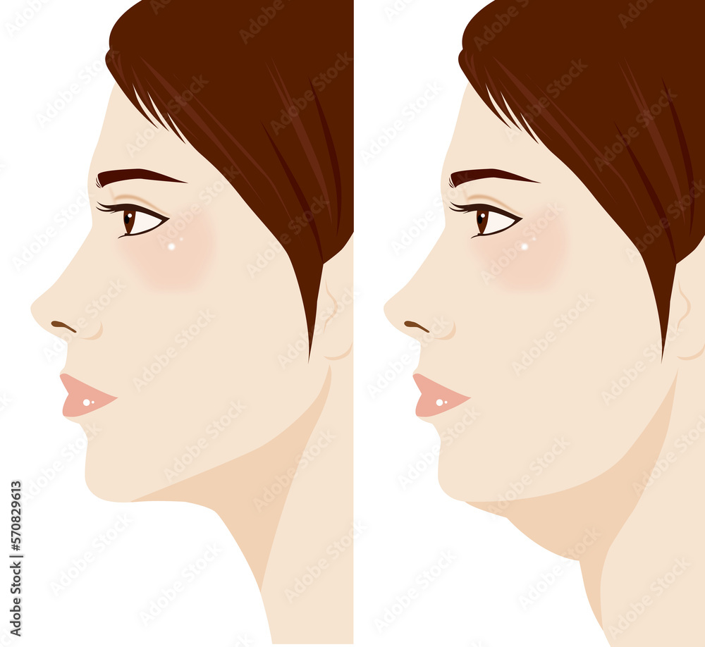 Fat senior woman face with a double chin, illustration compared before ...