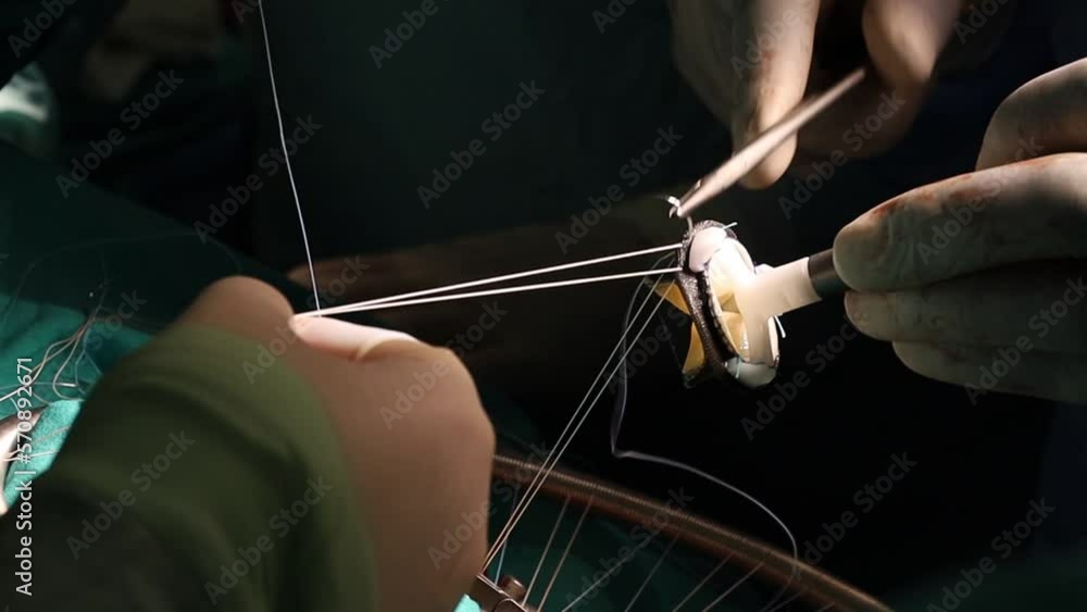 Suturing artificial heart valve. Close-up doctor hands and heart valve ...