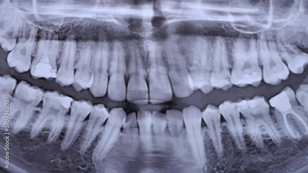X-ray image of the jaw of all human teeth close-up. Magnetic resonance ...
