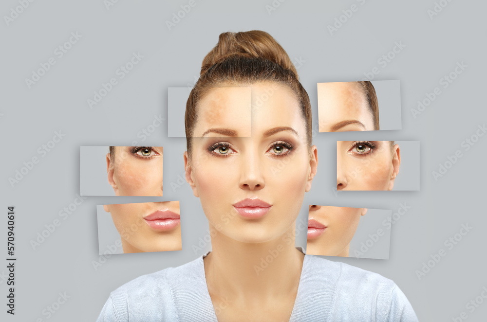 Dark spots, freckles,hyperpigmentation(melasma or chloasma),concept ...