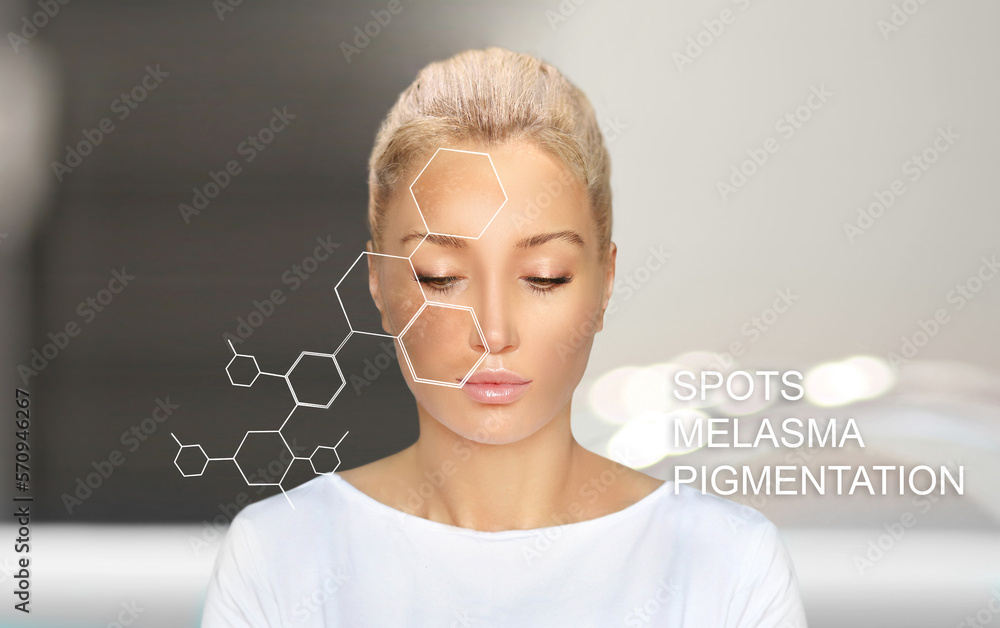 Dark spots, freckles,hyperpigmentation(melasma or chloasma),concept ...