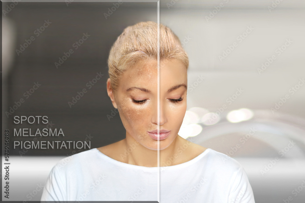 Foto Stock Dark spots, freckles,hyperpigmentation(melasma or chloasma ...