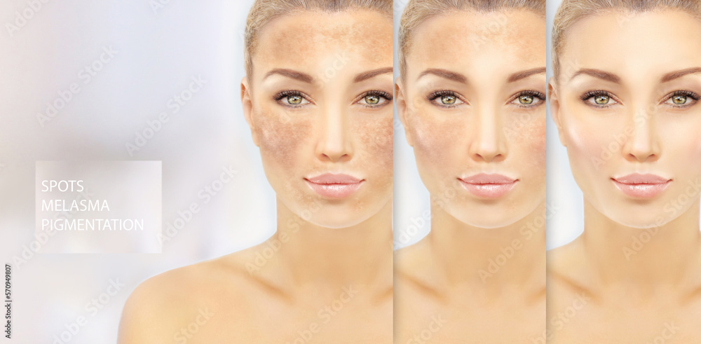 Dark spots, freckles,hyperpigmentation(melasma or chloasma),concept ...