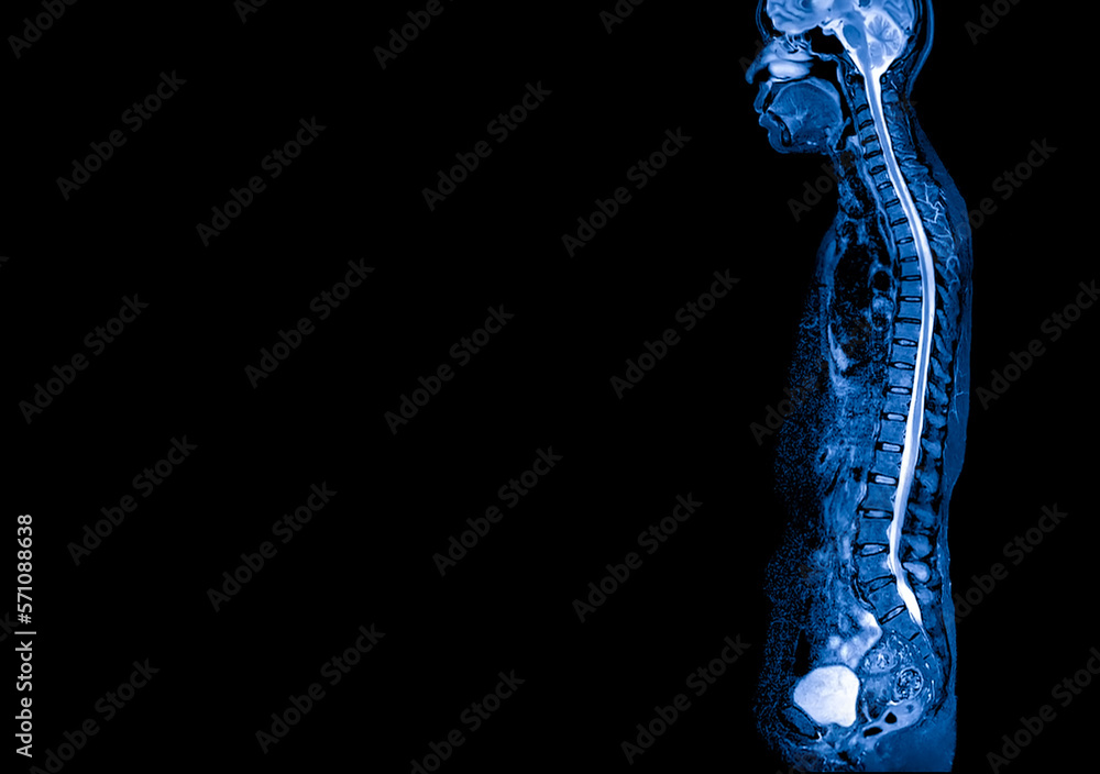 Blue tone radiograph on dark background in hospital.Doctor used MRI to ...