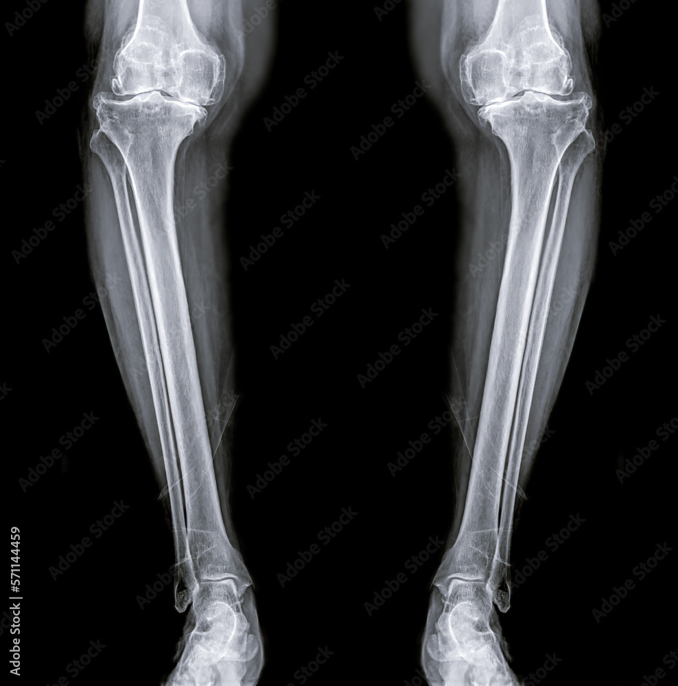film x-ray both Leg AP view for diagnosis knee pain from osteoarthritis ...