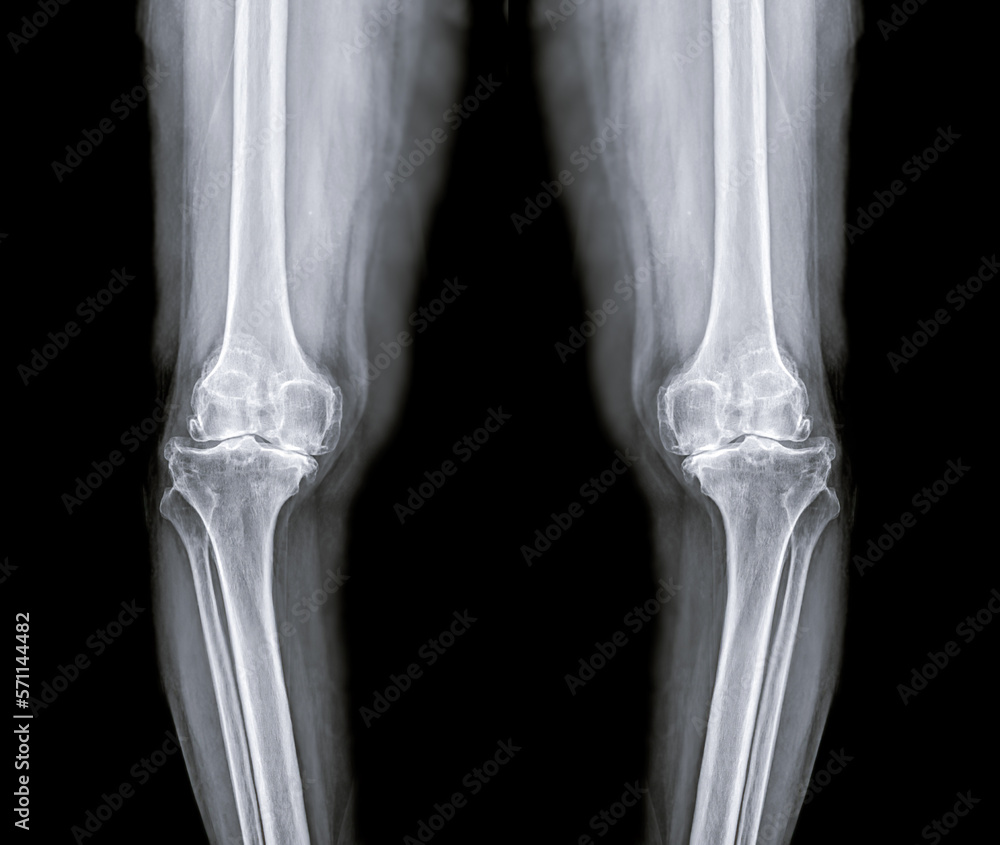 film x-ray both knee joint AP view for diagnosis knee pain from ...