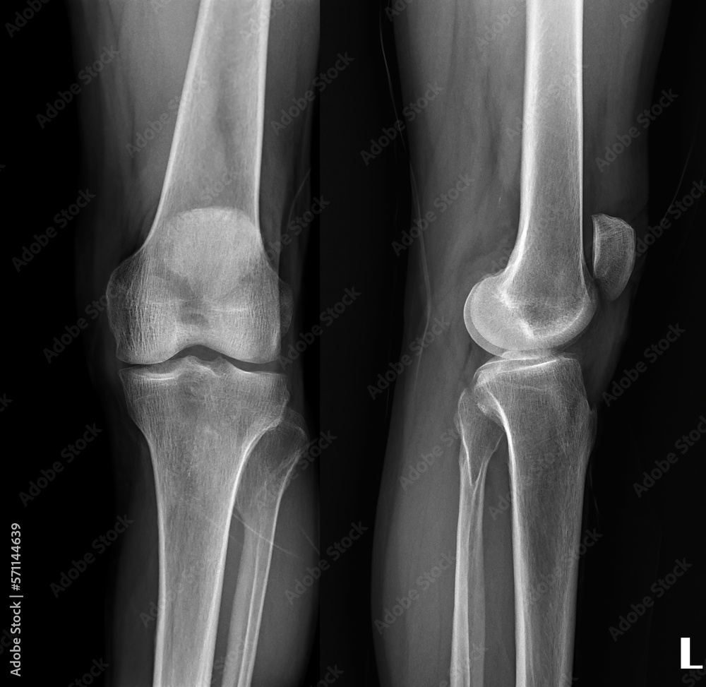 film x-ray both knee joint AP view for diagnosis knee pain from ...