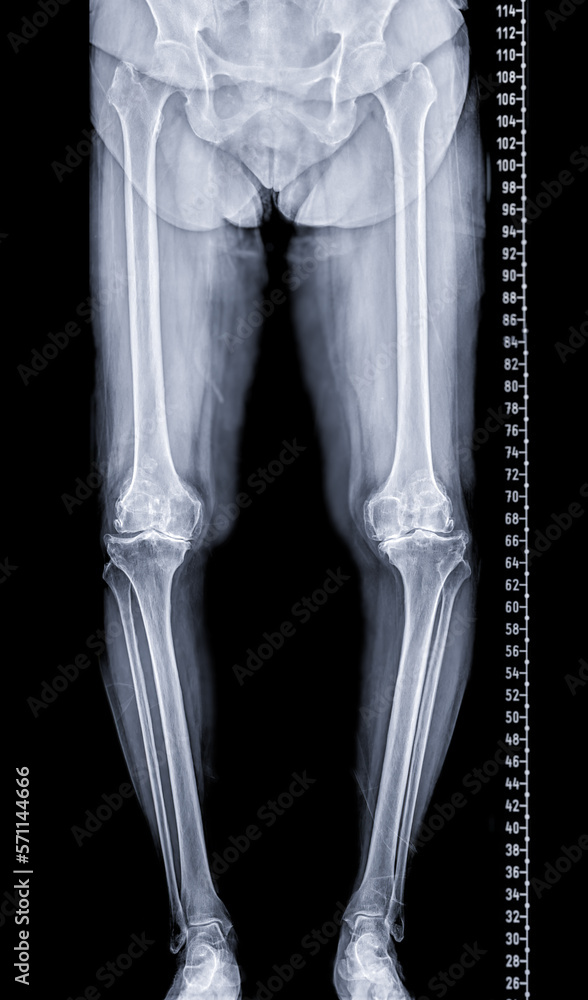 Poster Scanogram is a Full-length standing AP radiograph of both lower extremities including the ...