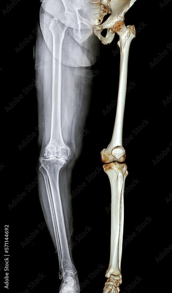 Scanogram is a Full-length standing AP radiograph of both lower ...