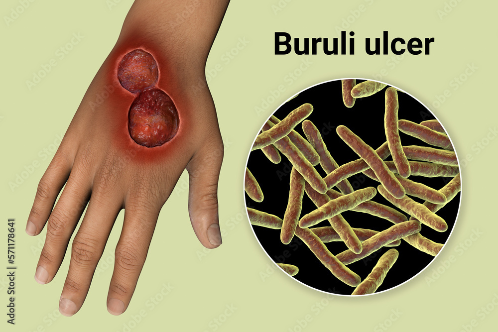 Buruli ulcer on an arm, 3D illustration. The disease caused by ...