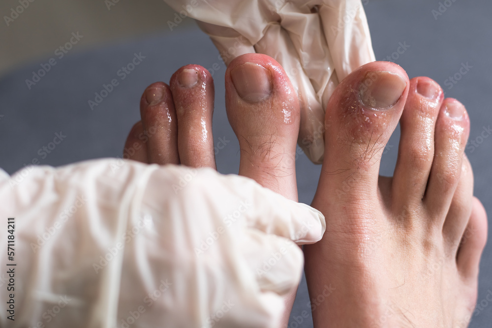 Covid toes. Coronavirus symptoms - swelling and discoloration, purplish ...