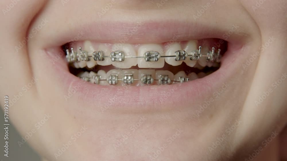 Orthodontic dental care concept. Woman with healthy teeth close up ...