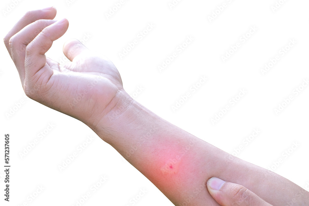 Swollen arms due to mosquito bites isolate on transparent background ...