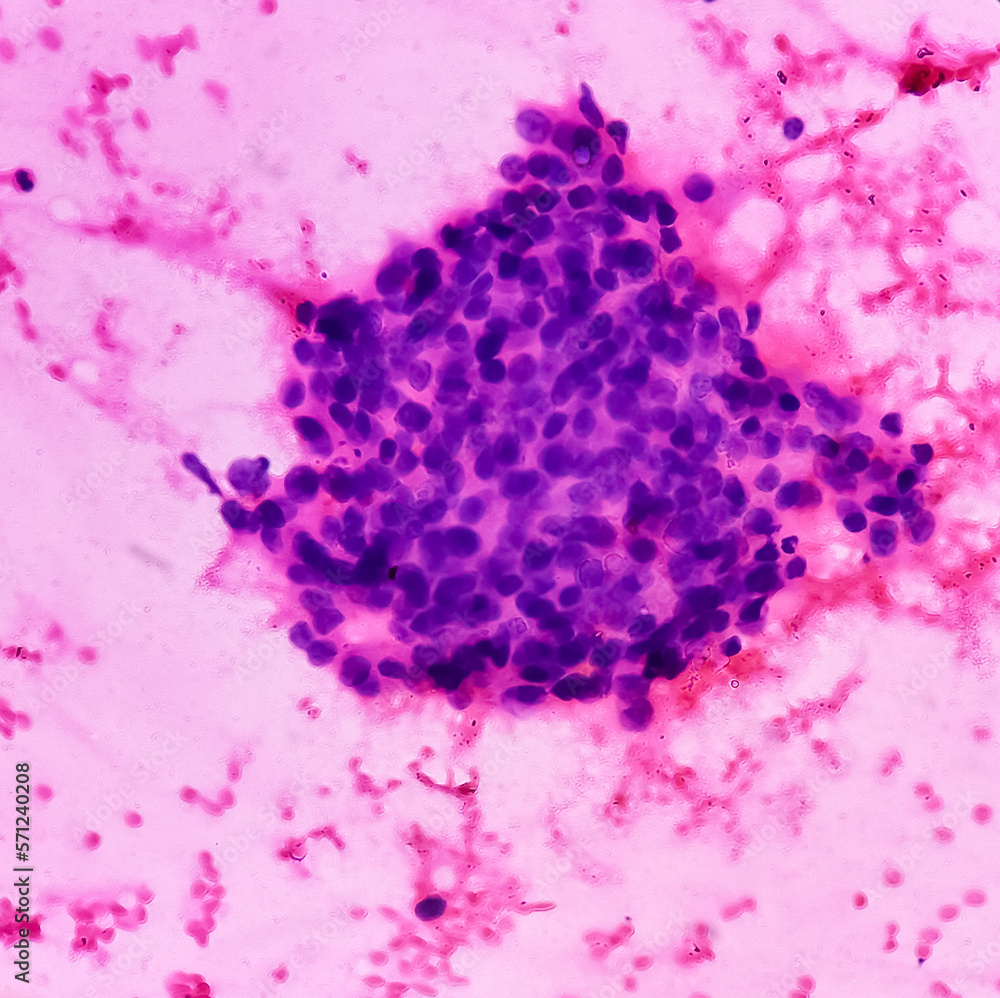 Breast lump(FNA Cytology): Proliferative breast disease with atypia ...