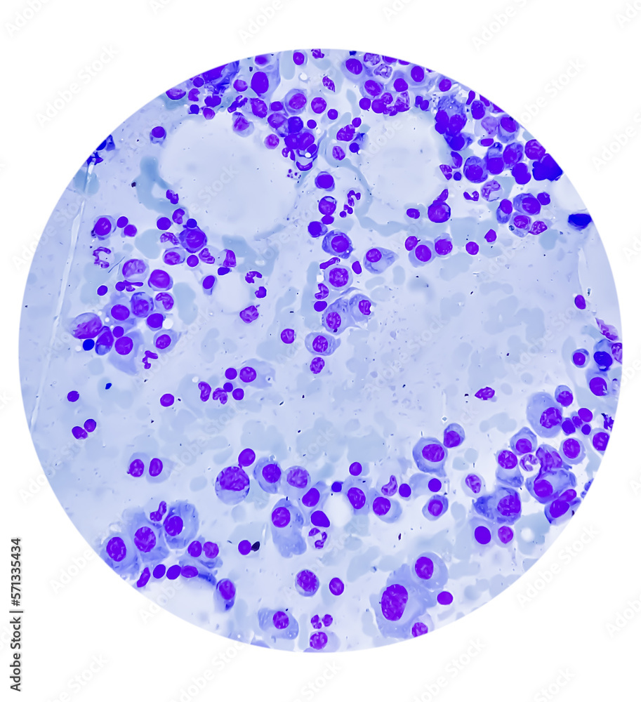 Microscopic view of bone marrow slide showing Multiple myeloma, also ...
