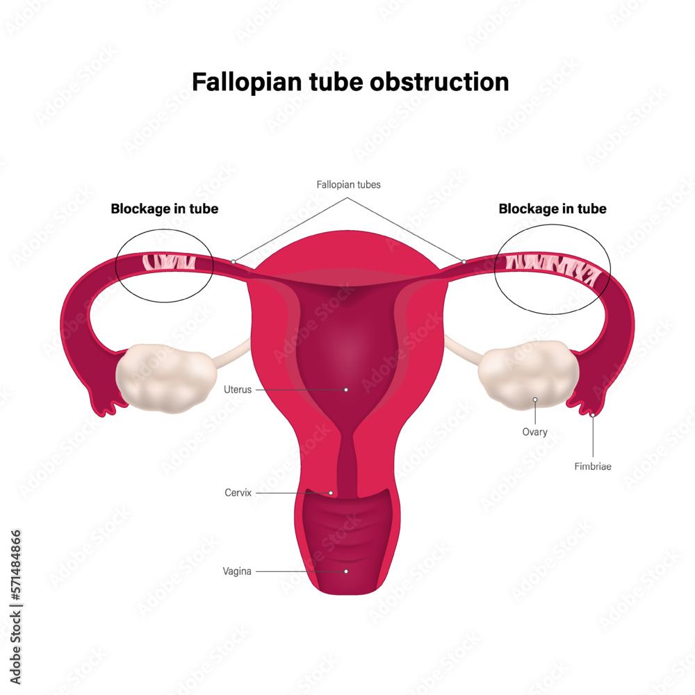 Fallopian tube obstruction. Block fallopian tube. Uterus and uterine ... Fallopian tube obstruction. Block fallopian tube. Uterus and uterine ...