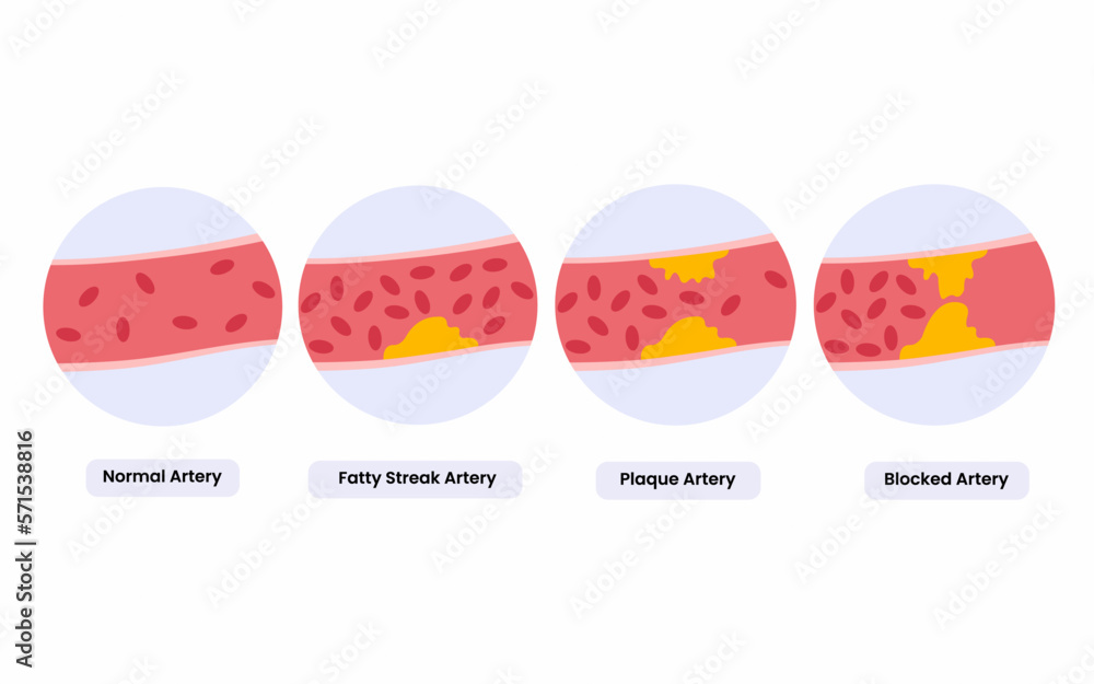 Types of cholesterol Normal artery, blocked artery, fatty streak ...