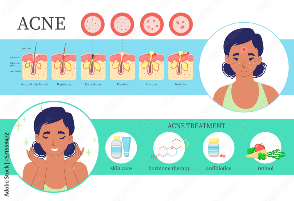 Acne flat vector face skin treatment infographic Stock Vector | Adobe Stock