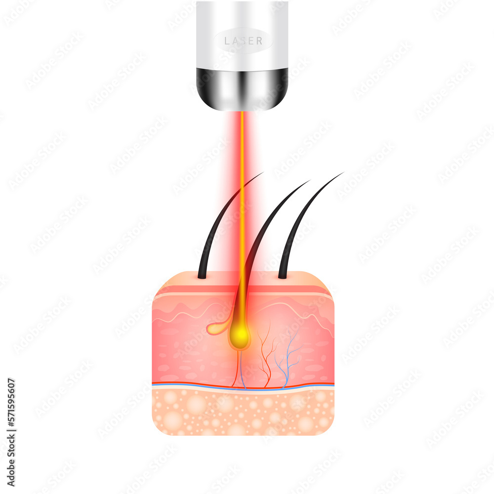 Skin Layers Anatomy With Hairs And Yellow Laser Light Hair Removal