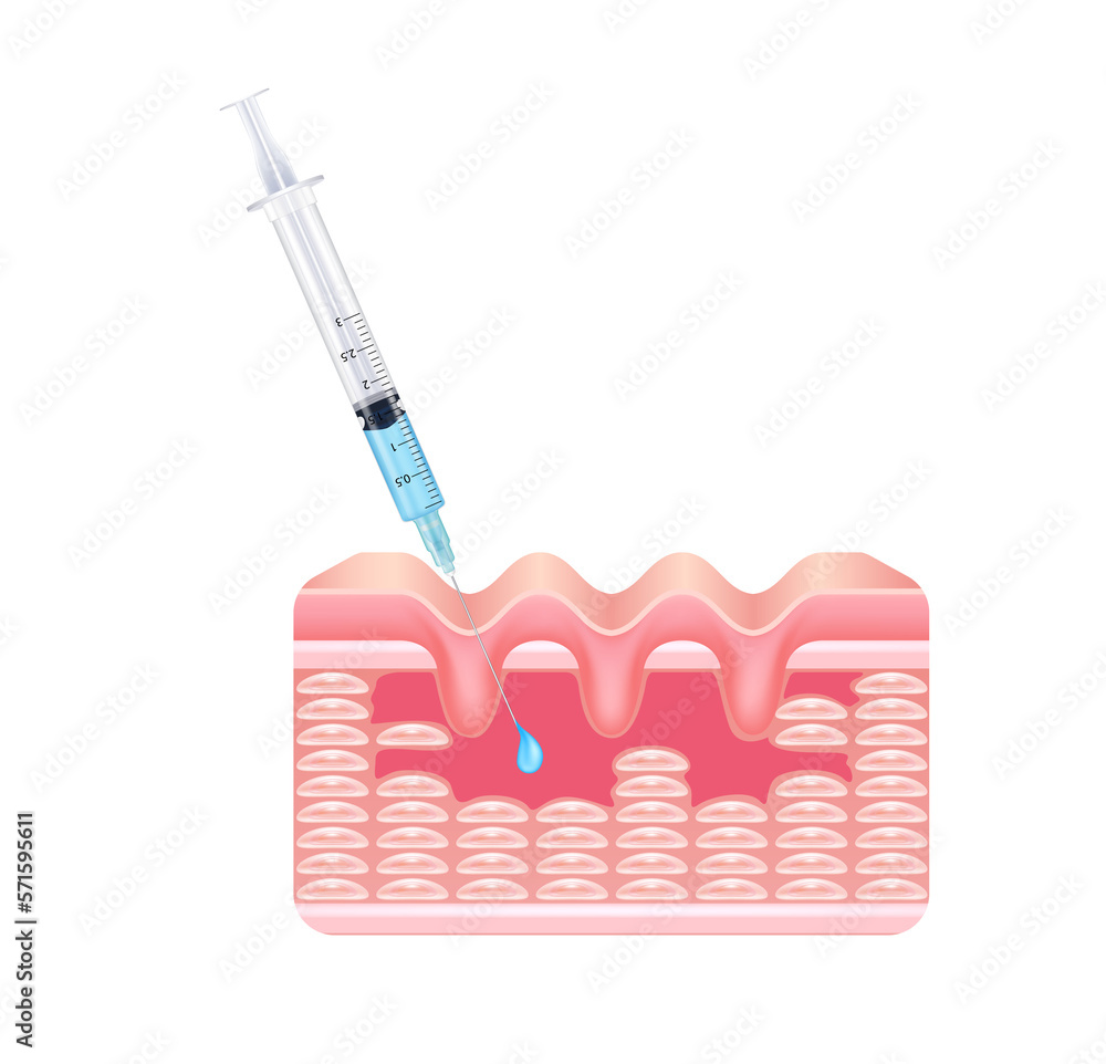 Injection filler and botox injection under the skin on face with ...