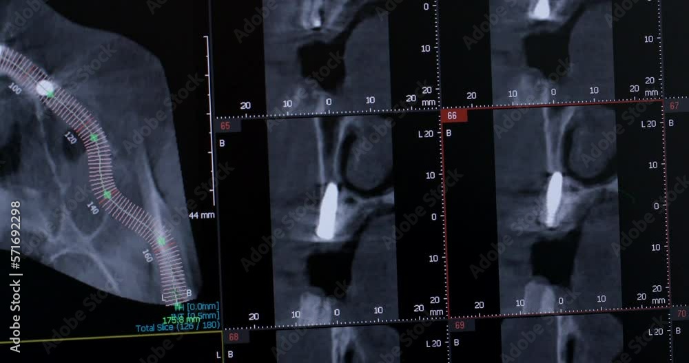3D X-ray Scanning dentalб MRI. Panoramic x-ray of the jaw on a computer ...