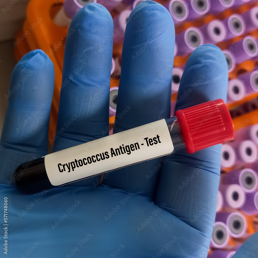 Blood sample for Cryptococcus Antigen test to diagnosis of cryptococcal ...