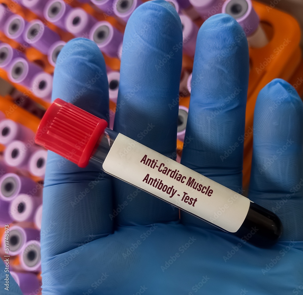 Blood sample for Anti-cardiac muscle antibdy test, these ABs are found ...