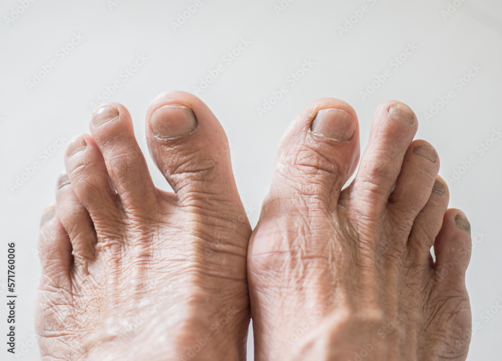 Brittle Toenails
