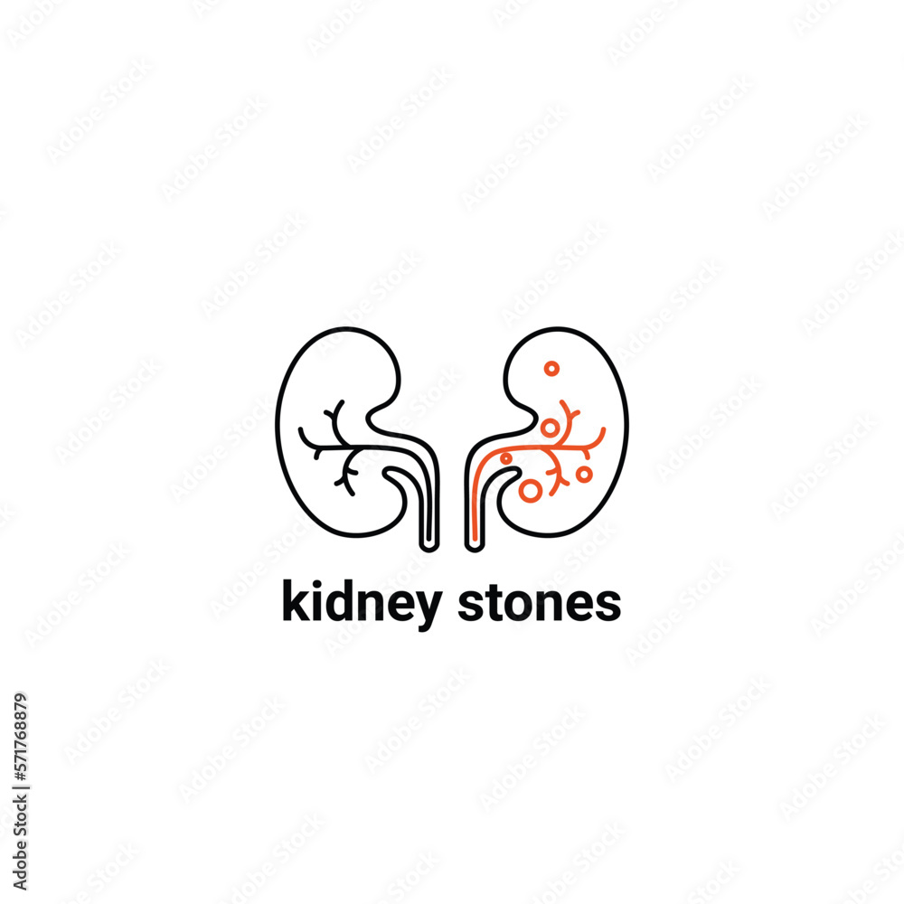 Human organ symbol, kidney stones problem. Modern vector line icons of ...