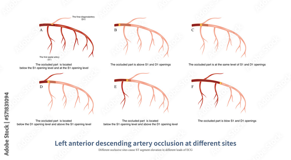When different parts of the left anterior descending artery are ...