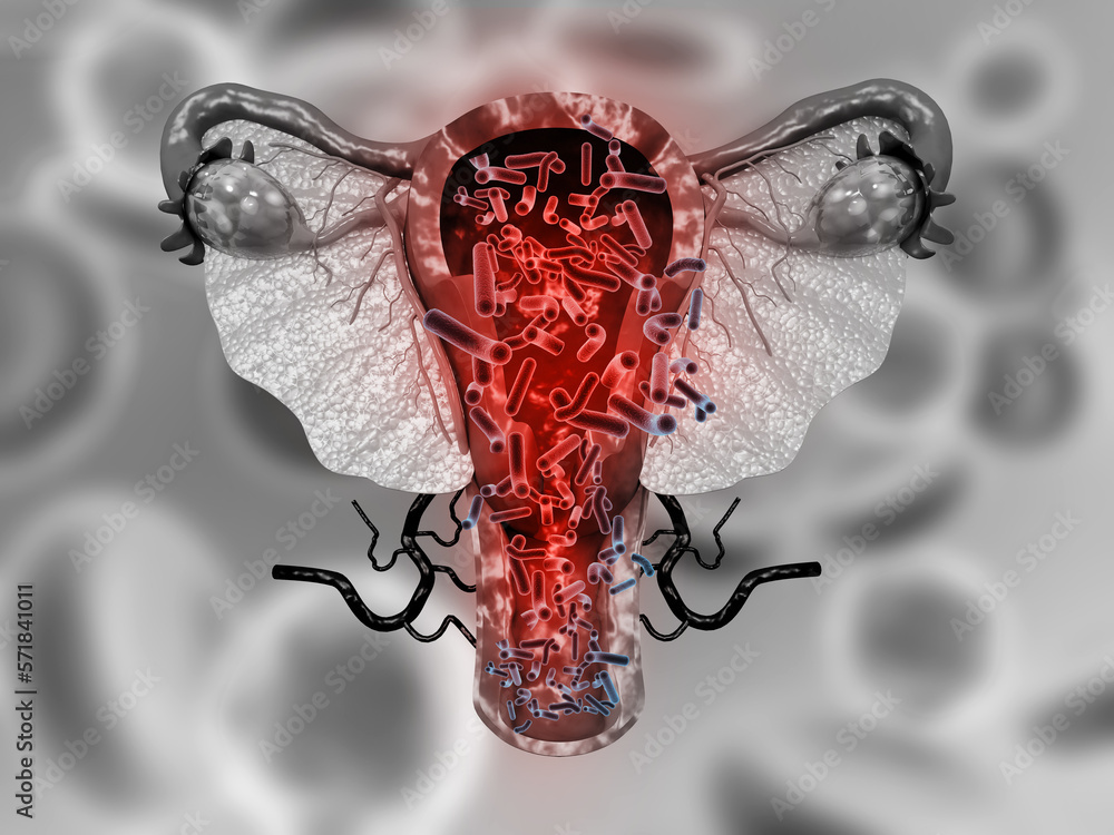 Uterus uterus infection. bacterial growth. 3d illustration.. Stock ...