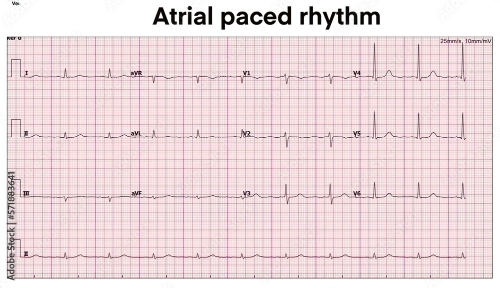 Electrocardiogram show atrial paced rhythm. Cardiac Pacemaker. Heart beat. CPR. ECG. EKG. Vital ...