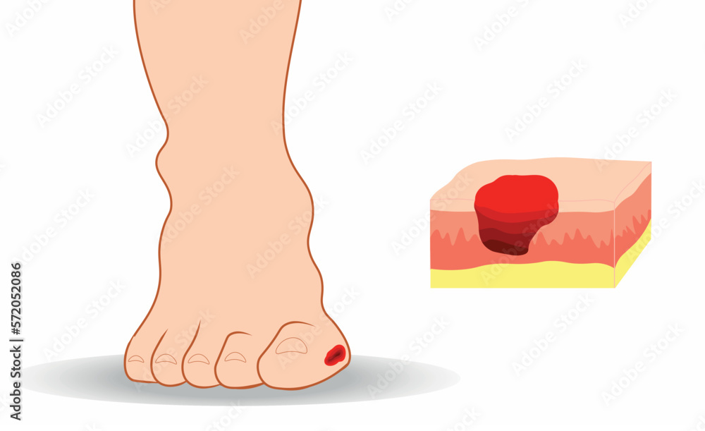 Diabetic foot illustration. Ulcer in the toe and an isolated skin ...