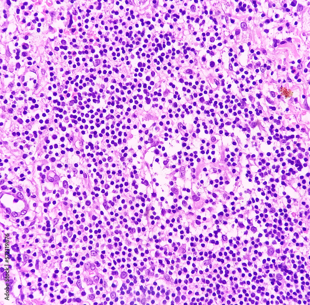 Photo Perianal abscess tissue: Foreign body granuloma, microscopically ... Photo Perianal abscess tissue: Foreign body granuloma, microscopically ...