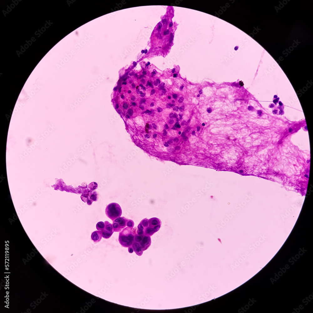 Ascetic fluid cytology, Malignant cells, Metastatic adenocarcinoma ...