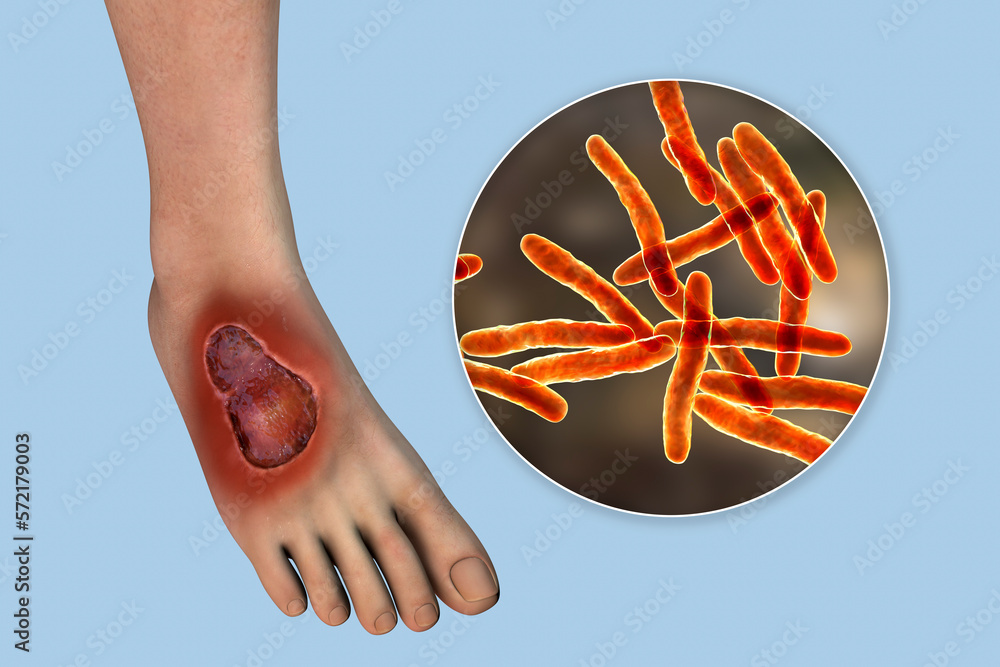 Buruli ulcer on a patient foot, 3D illustration. The disease caused by ...