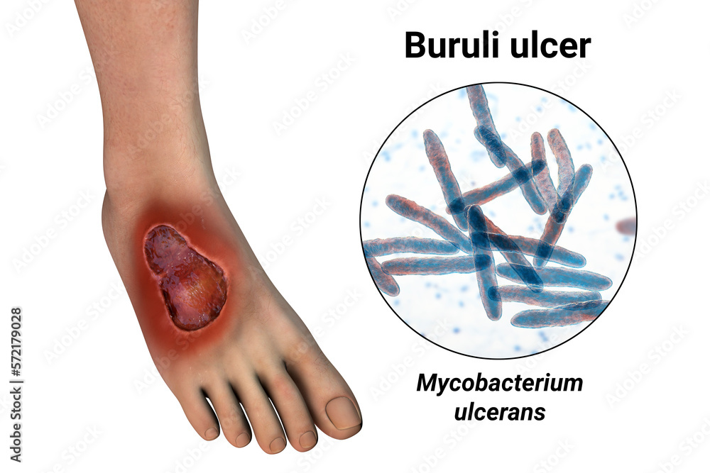 Buruli ulcer on a patient foot, 3D illustration. The disease caused by ...