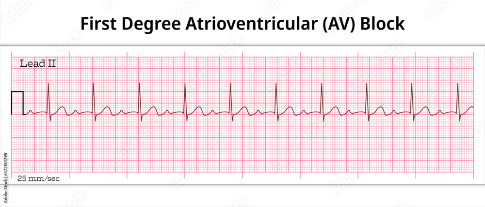 Ecg First Degree Atrioventricular Block 1st Degree Av Block 8 Second Ecg Paper