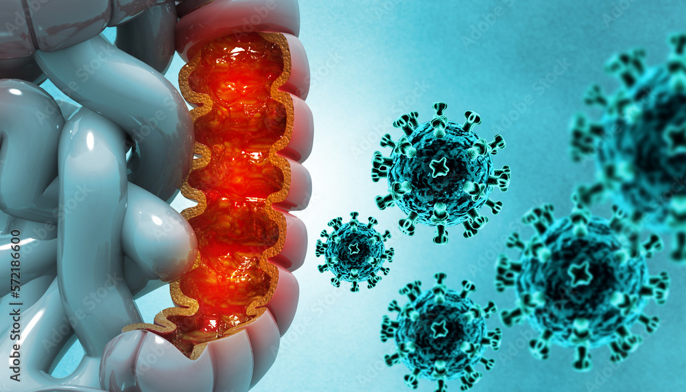 Colon cancer, viruses, bacterias in sick unhealthy intestine. Colon ...