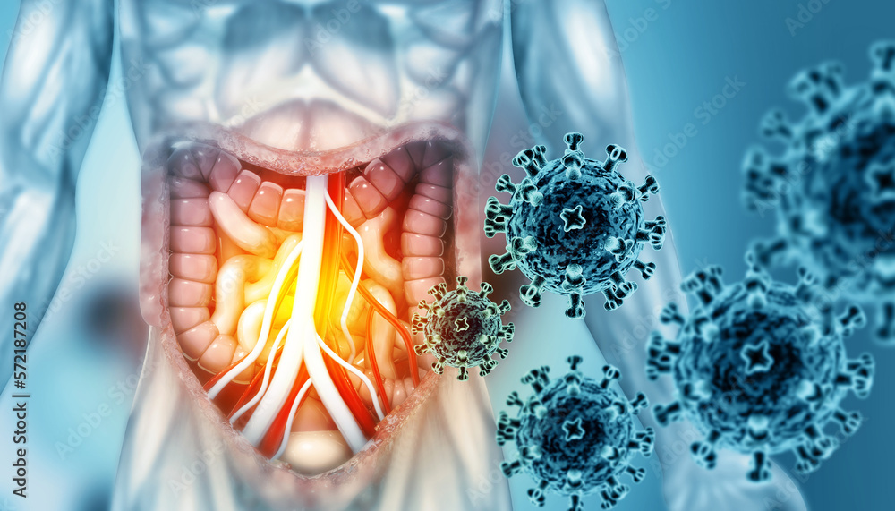 Colon cancer. Cancer attacking cells. Colon disease concept. 3d ...