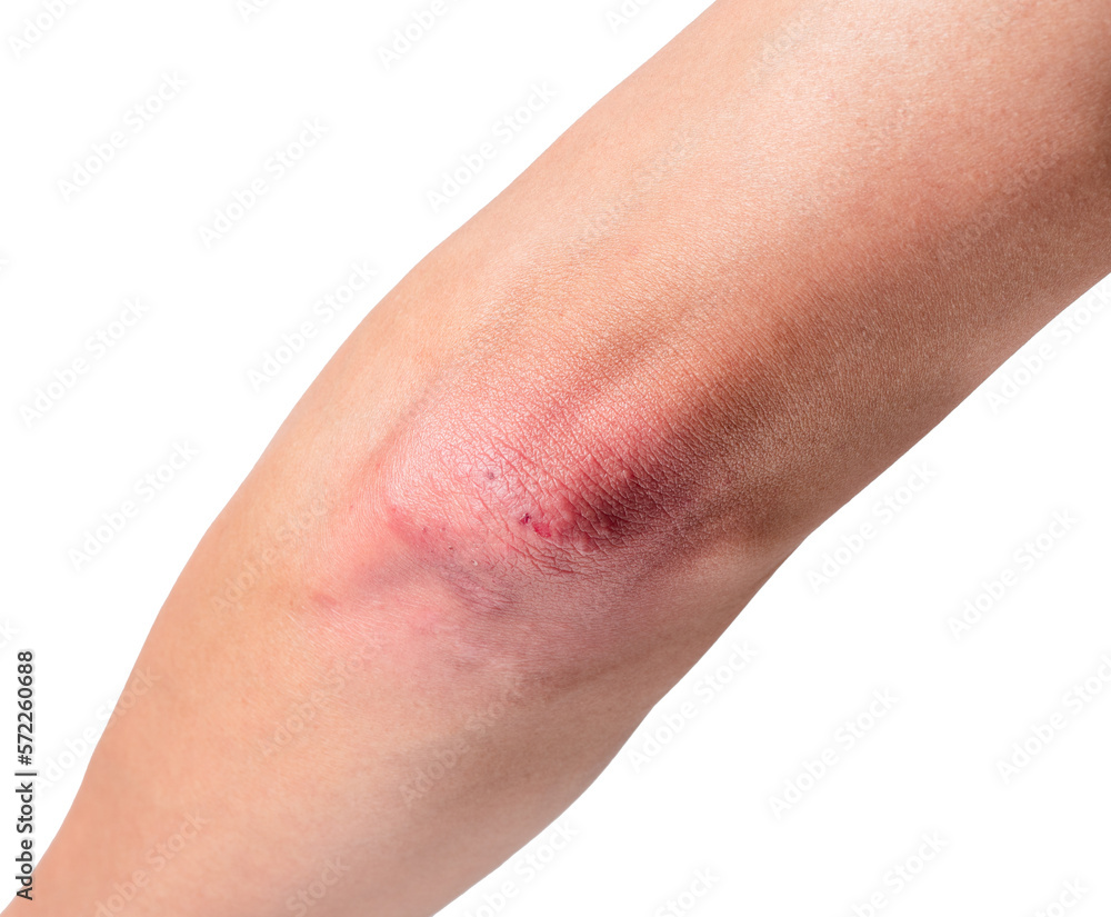 Atopic dermatitis of the elbow on white background. Stock Photo | Adobe ...